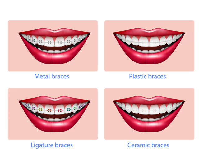 Best Dental Braces - Straighten Your Teeth with Arty Smile